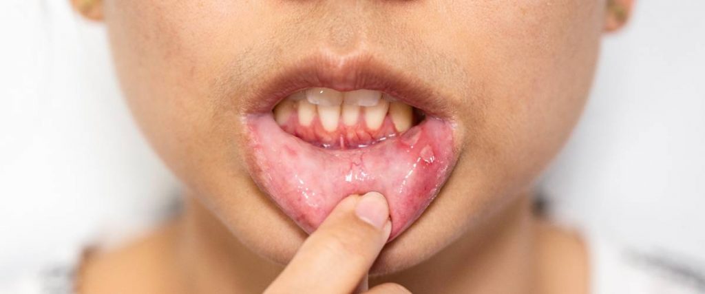 Aftas, llagas y úlceras bucales: productos de farmacia efectivos